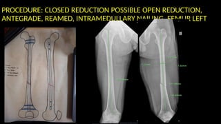 Pre operative conference diaphyseal Femur.pptx