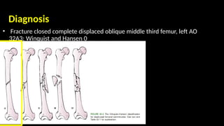 Pre operative conference diaphyseal Femur.pptx