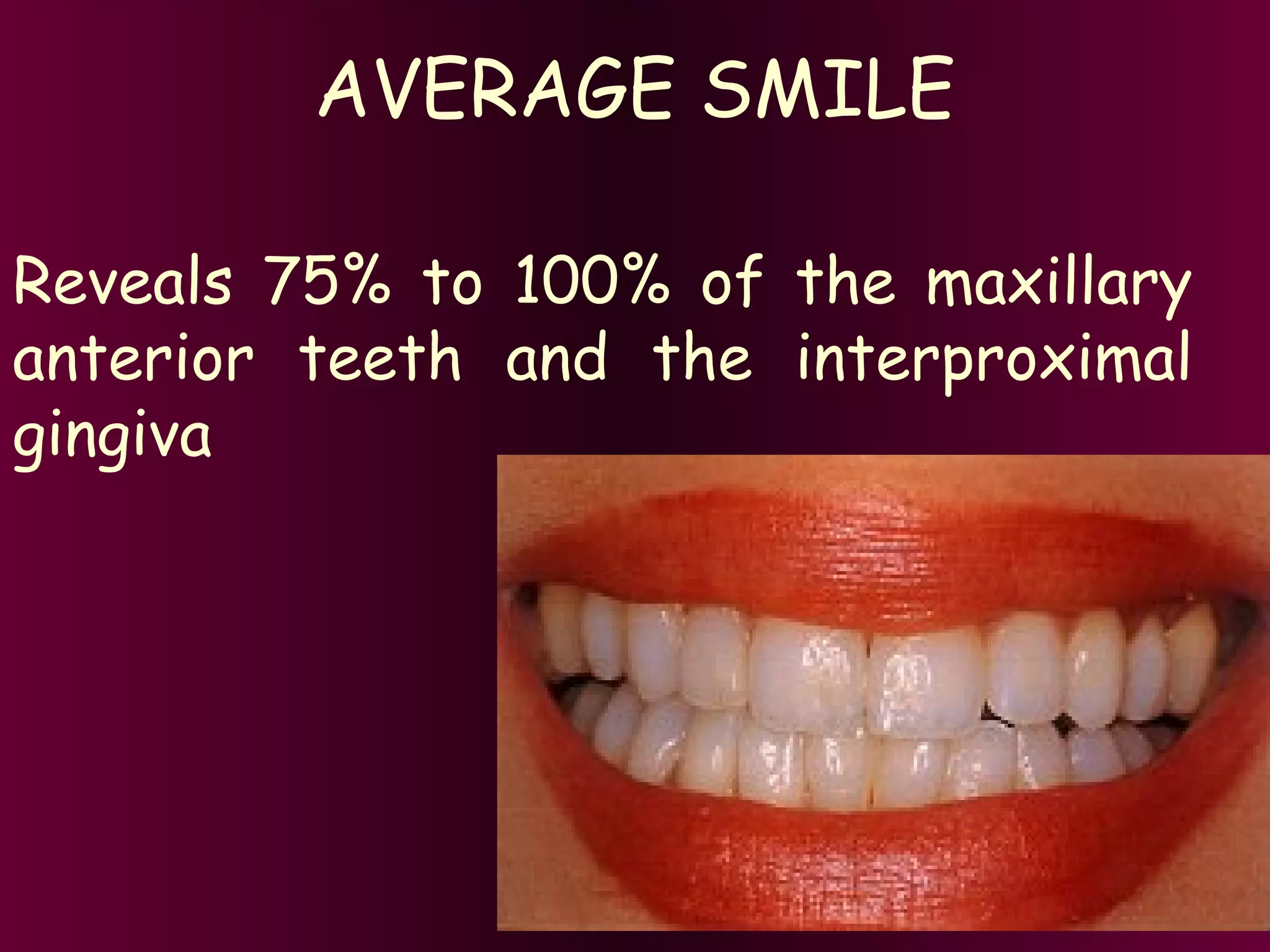 The smile line and its importance in treatment planning | PPT | Dental ...