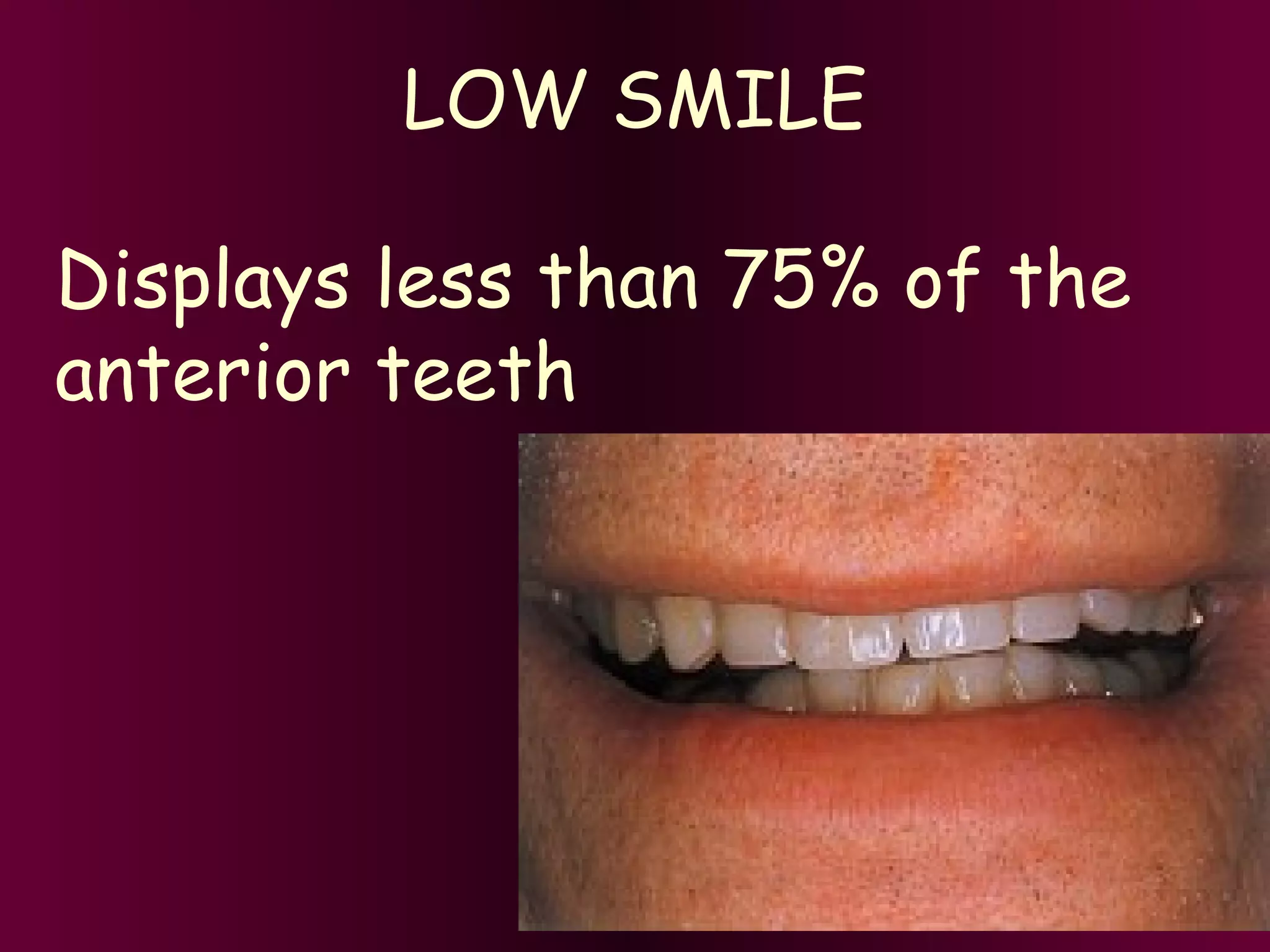 The smile line and its importance in treatment planning | PPT | Dental ...