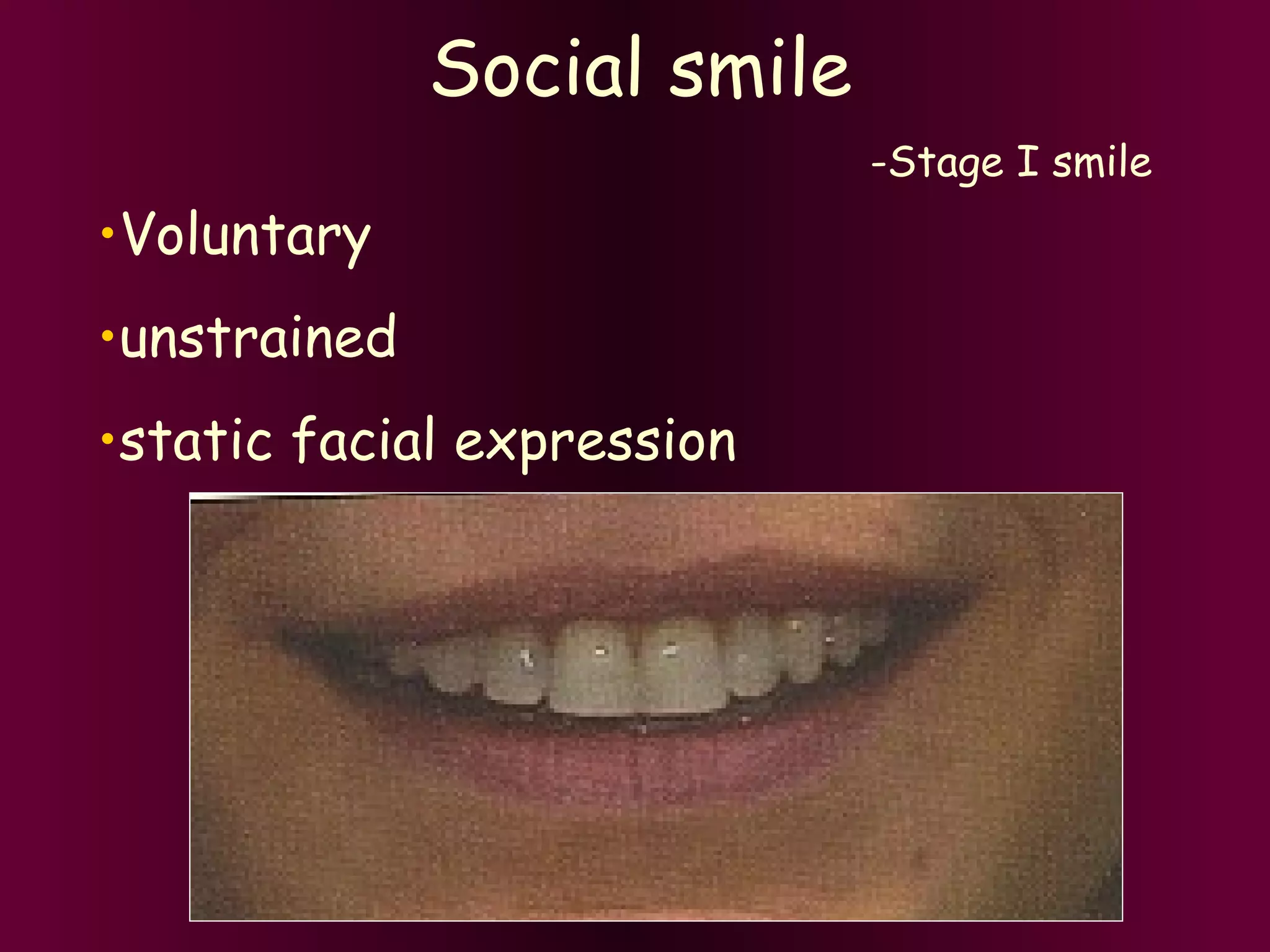 The smile line and its importance in treatment planning | PPT | Dental ...