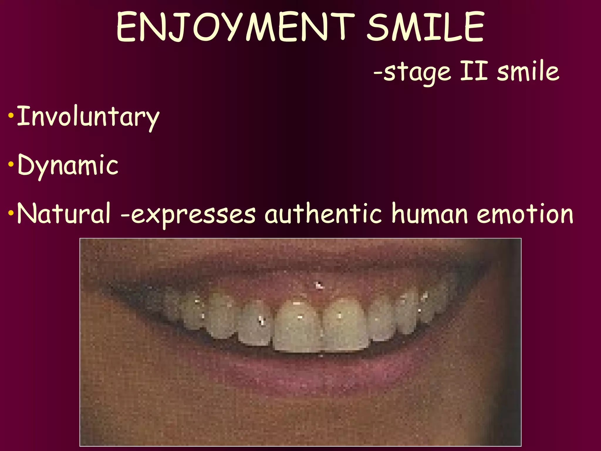 The smile line and its importance in treatment planning | PPT | Dental ...