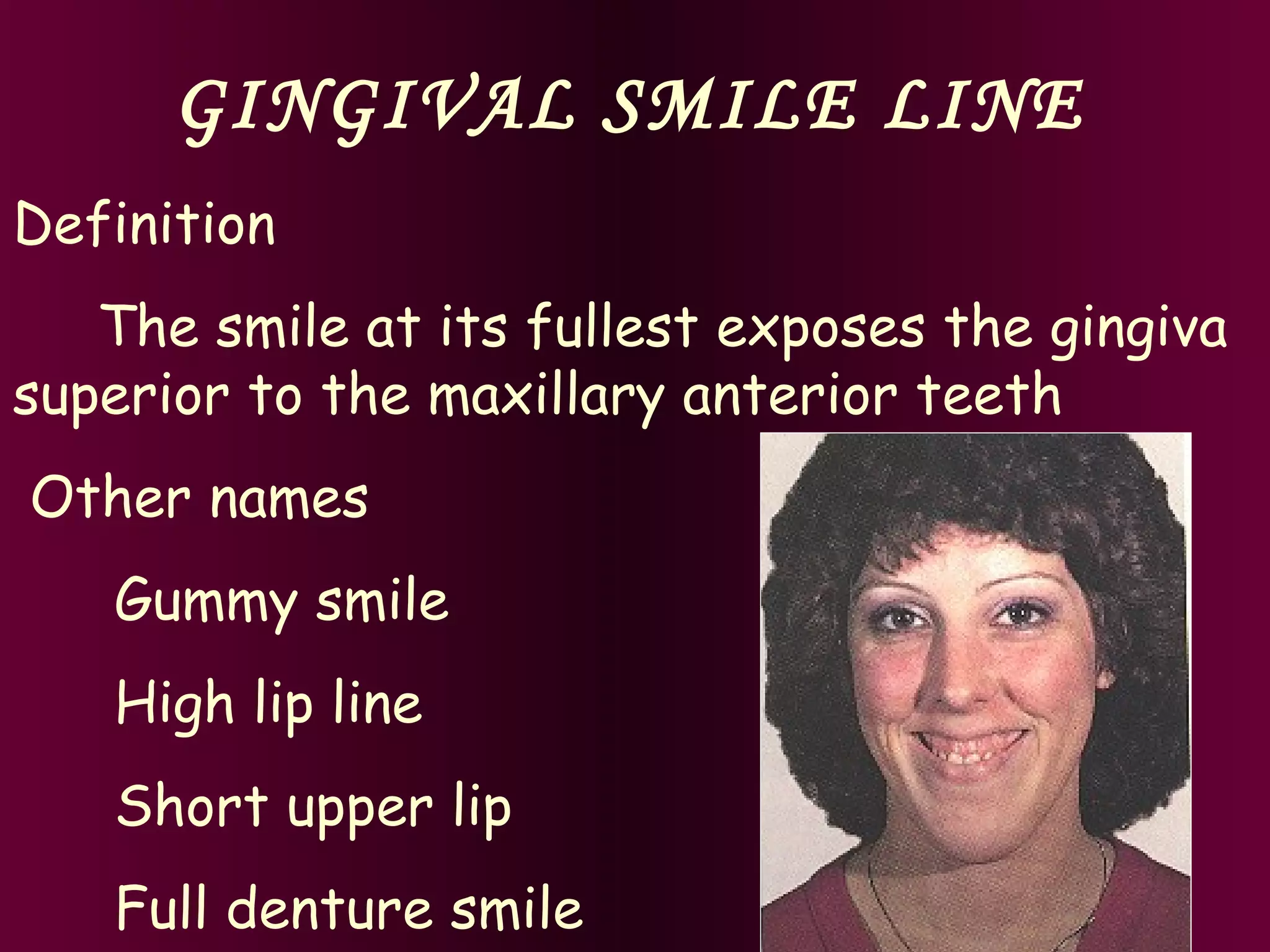 The smile line and its importance in treatment planning | PPT | Dental ...
