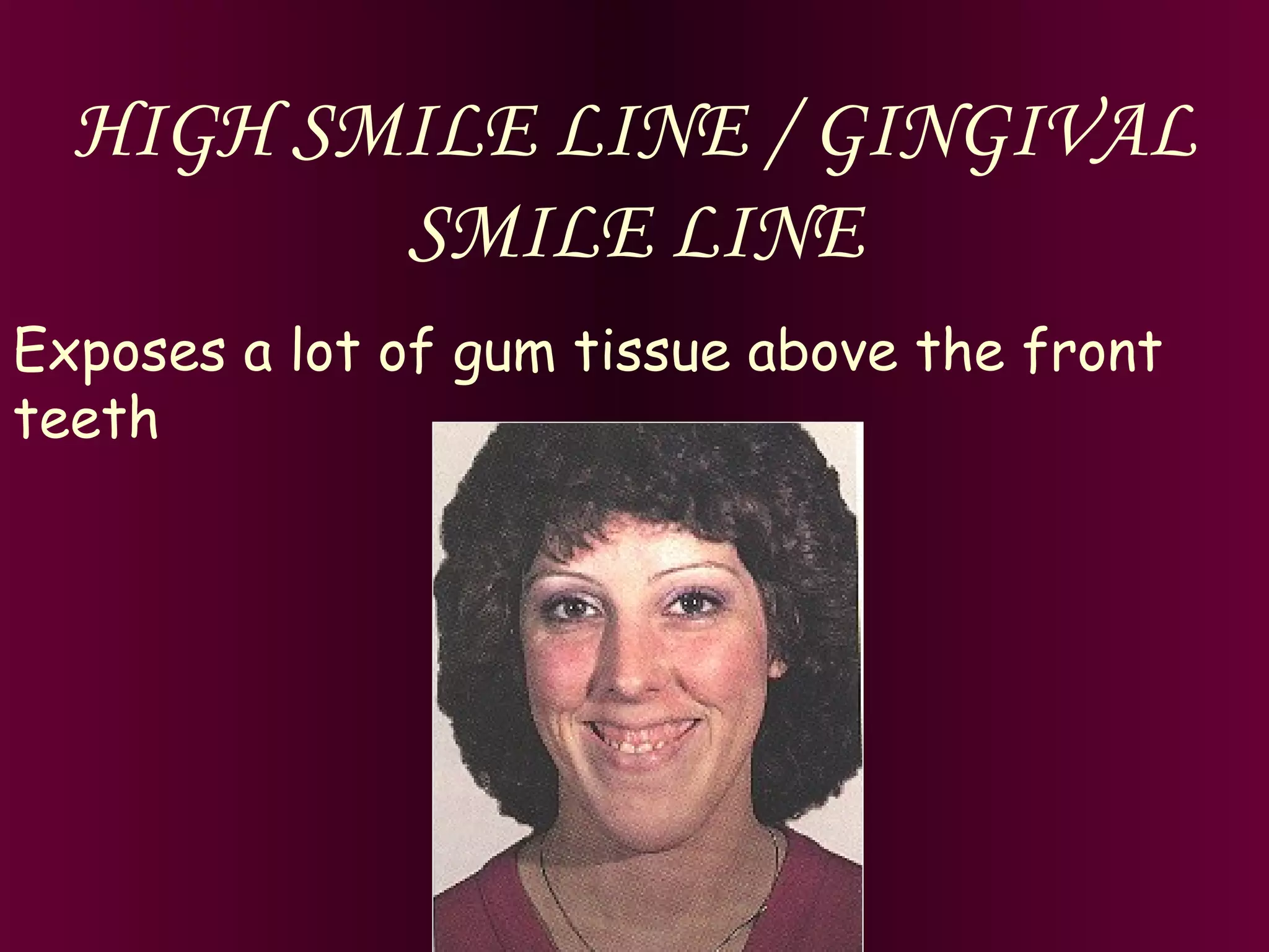 The smile line and its importance in treatment planning | PPT