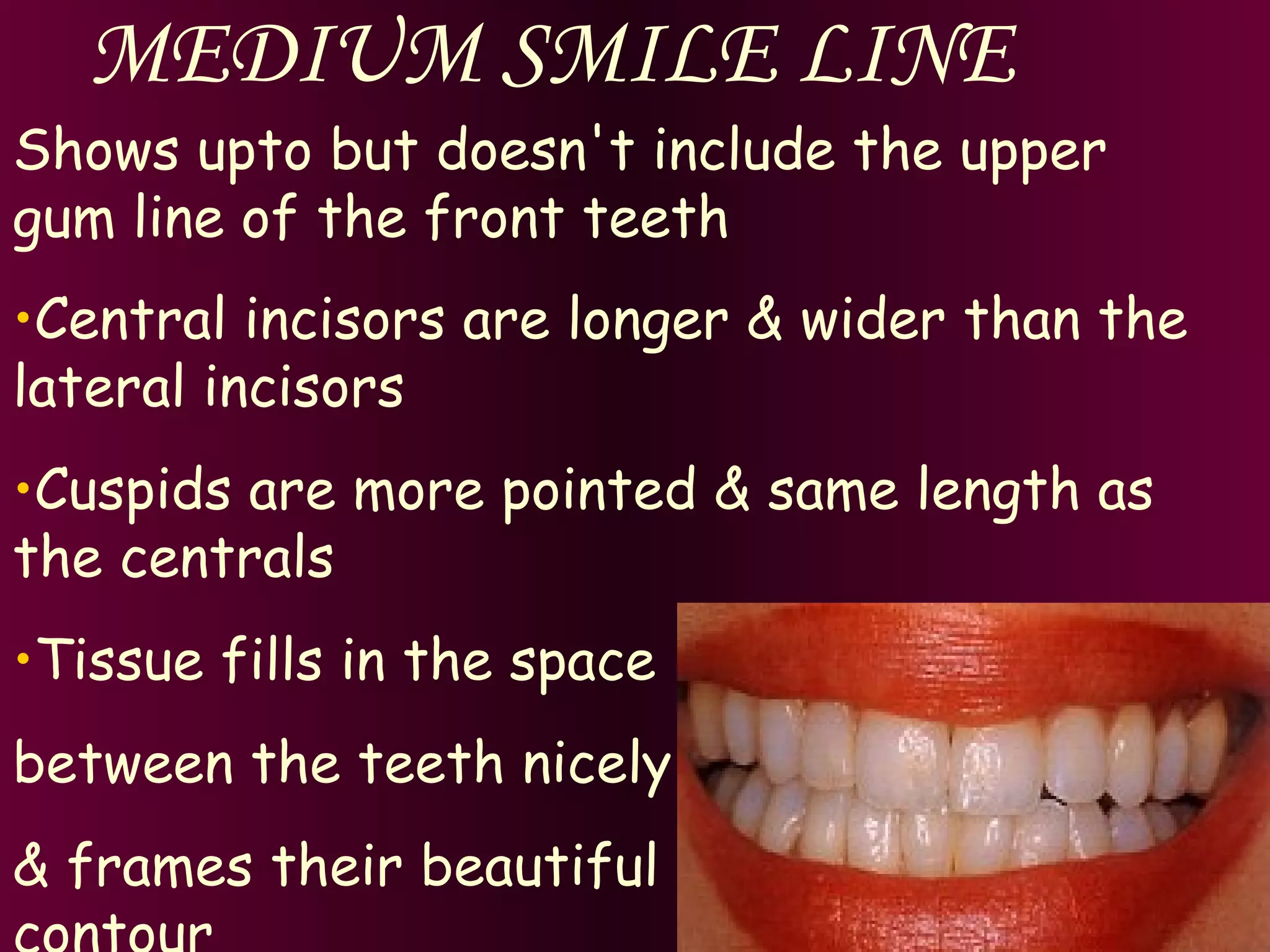 The smile line and its importance in treatment planning | PPT | Dental ...