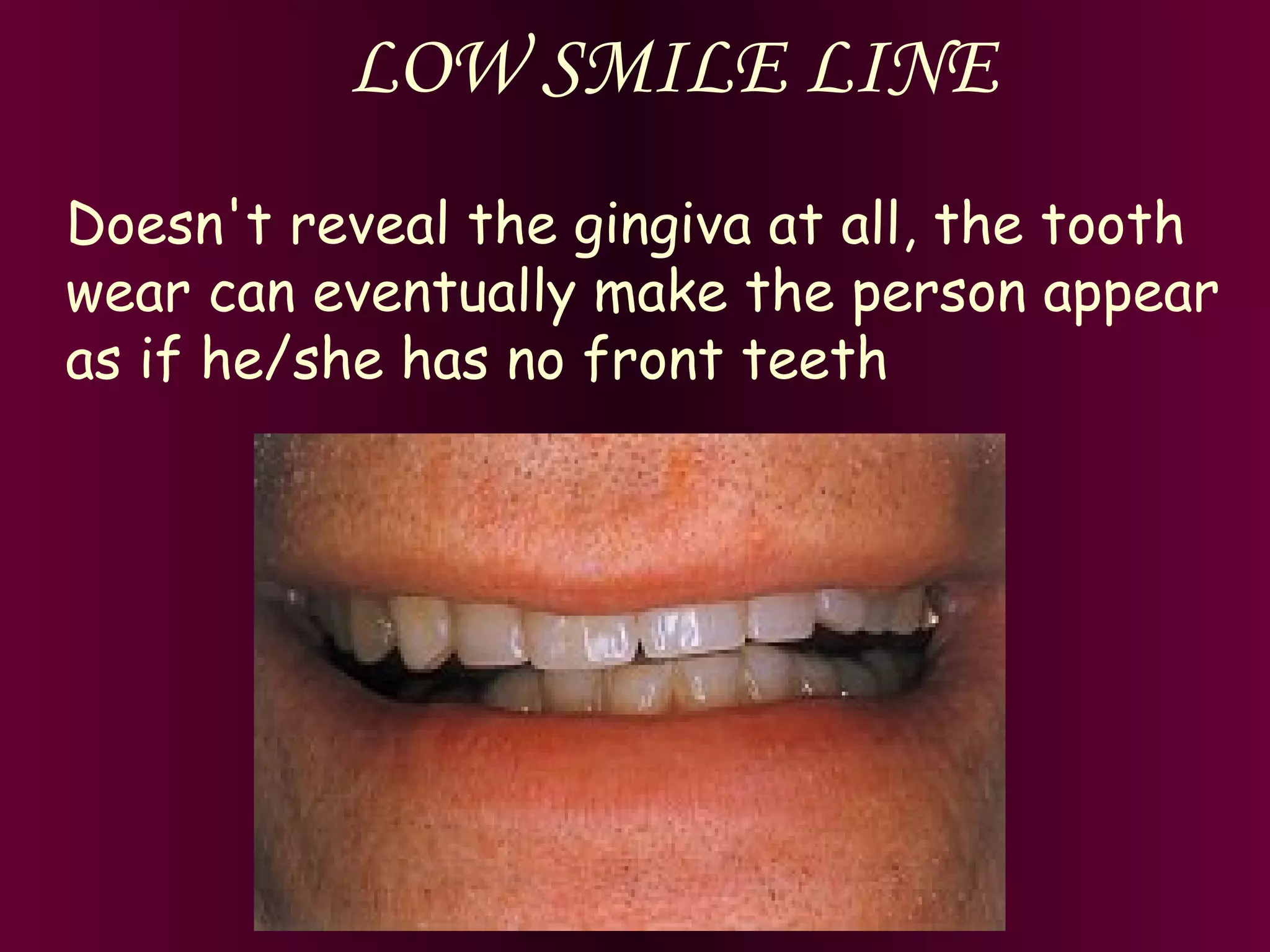 The smile line and its importance in treatment planning | PPT | Dental ...