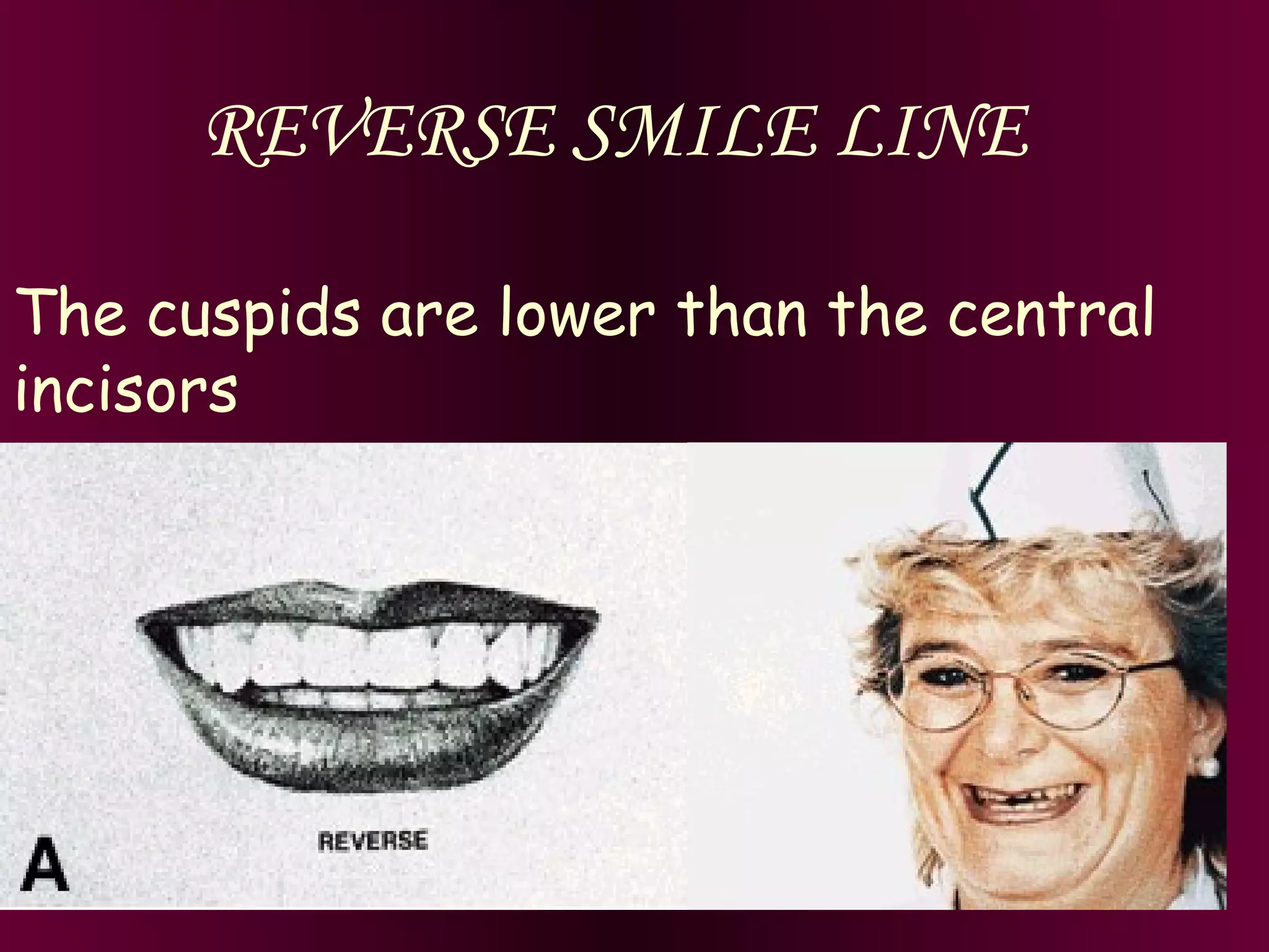 The smile line and its importance in treatment planning | PPT