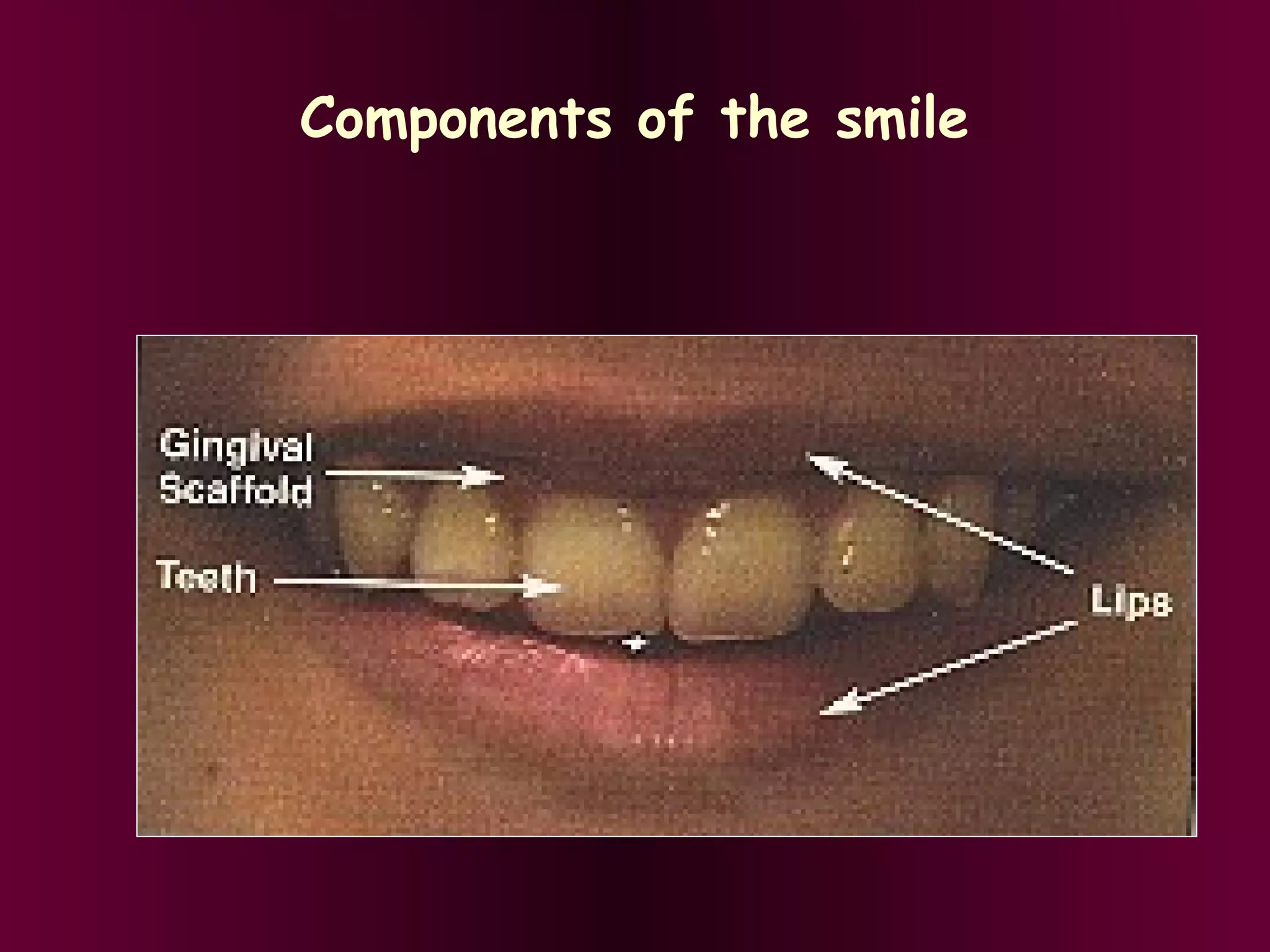 The smile line and its importance in treatment planning | PPT | Dental ...