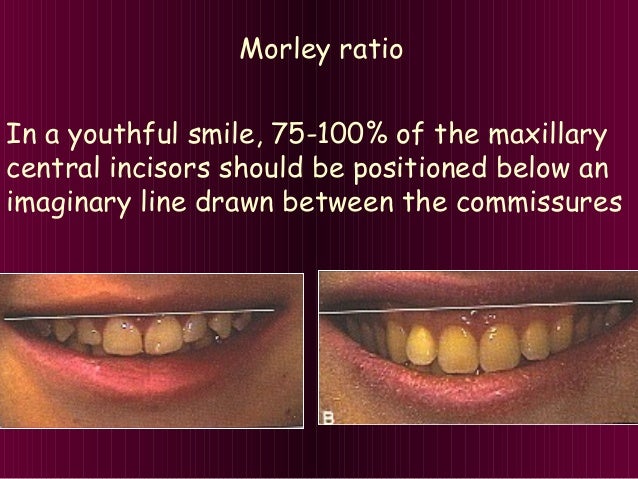 The smile line and its importance in treatment planning