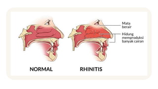 871196591-Rhinitis-Alergi-Kelompok-4.pdf