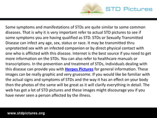 The #1 resource for STD pictures and photos | PPTX
