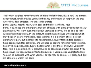 The #1 resource for STD pictures and photos | PPTX