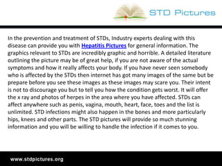 The #1 resource for STD pictures and photos | PPTX
