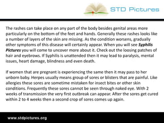The #1 resource for STD pictures and photos | PPTX
