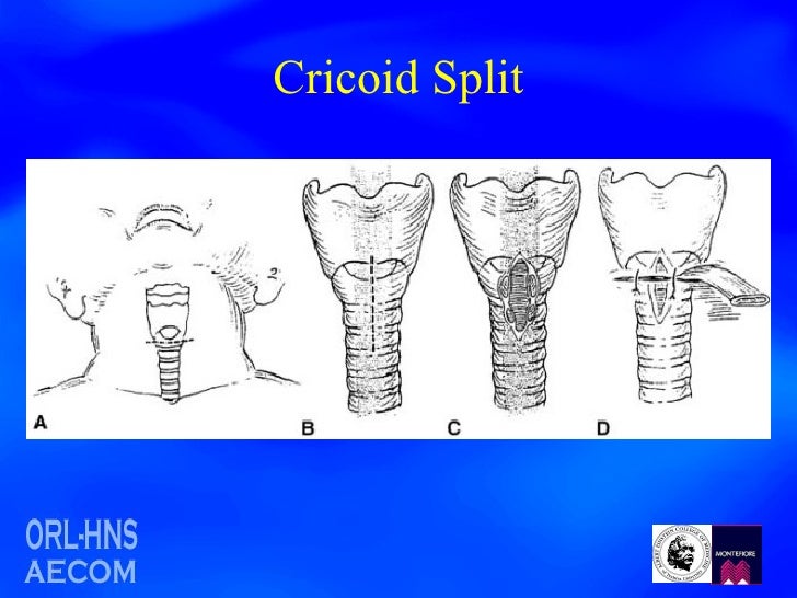 8737 Coclia 84 Glottic Ans Subglottic Stenosis