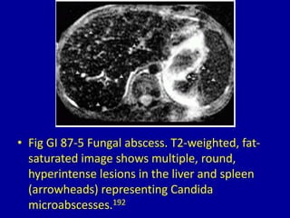87 splenic lesions on magnetic resonance imaging | PPT