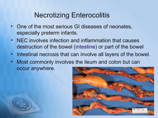 necrotizing enterocolitis | PPT
