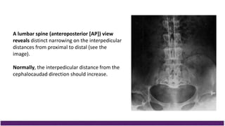 Achondroplasia | PPTX