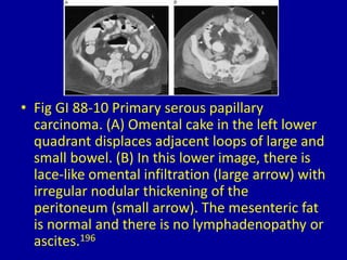 88 peritoneal and omental abnormalities | PPTX | Digestive Disorders ...