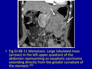 88 peritoneal and omental abnormalities | PPTX