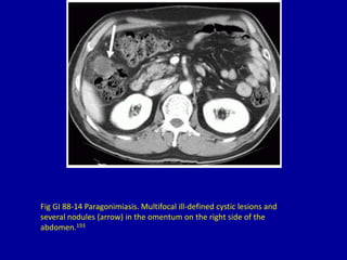 88 peritoneal and omental abnormalities | PPTX | Digestive Disorders ...