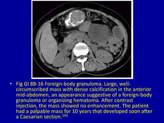 88 peritoneal and omental abnormalities | PPTX | Digestive Disorders ...
