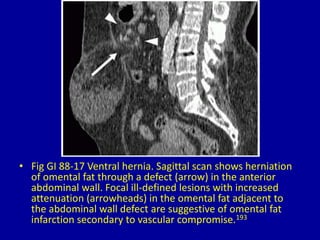 88 peritoneal and omental abnormalities | PPTX | Digestive Disorders ...