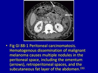 88 peritoneal and omental abnormalities | PPTX | Digestive Disorders ...