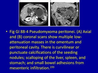 88 peritoneal and omental abnormalities | PPTX | Digestive Disorders ...