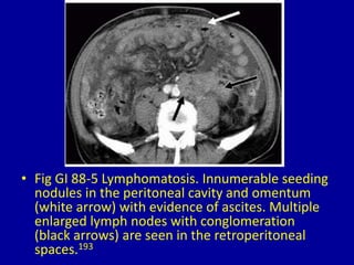 88 peritoneal and omental abnormalities | PPTX | Digestive Disorders ...