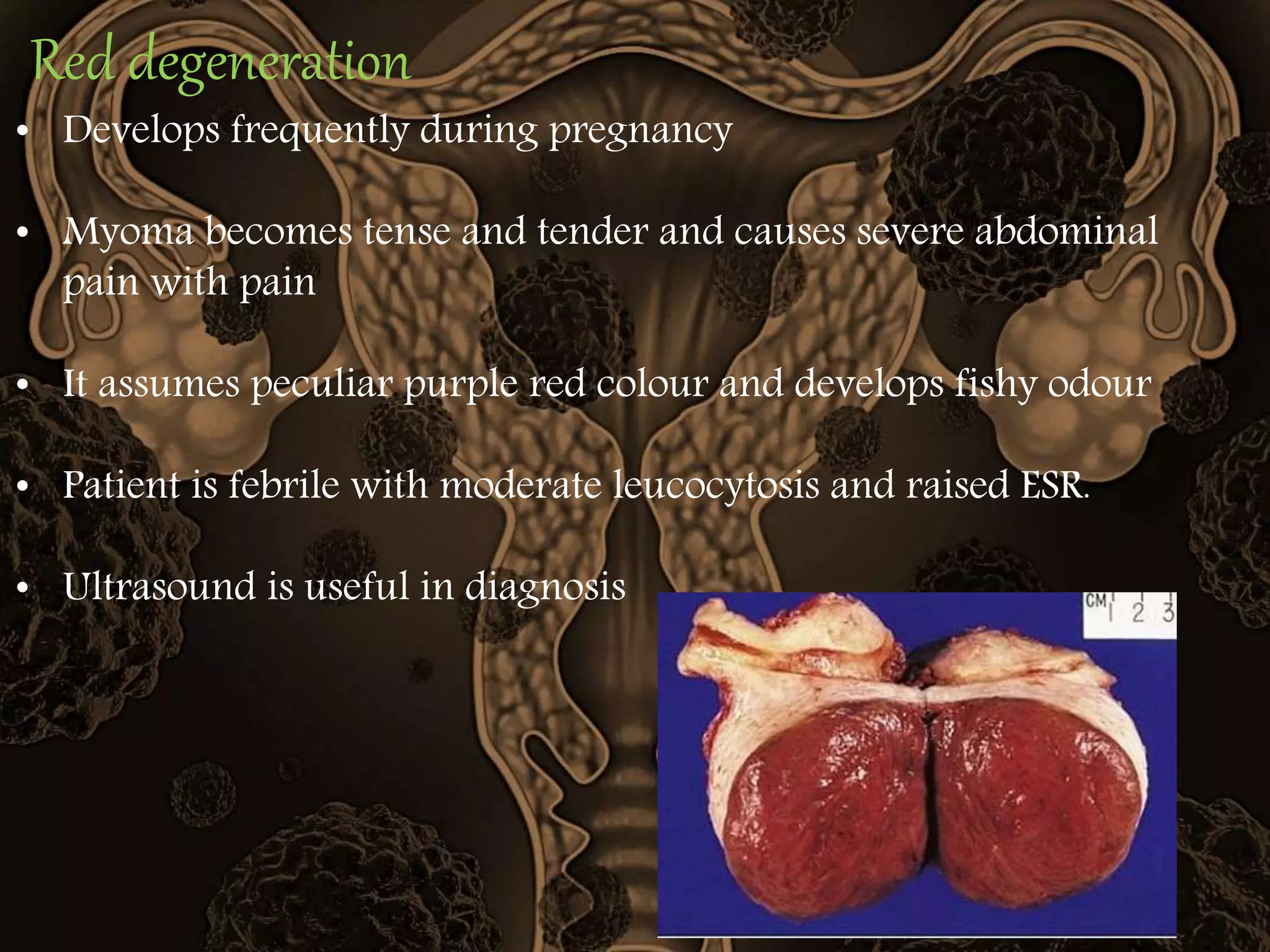 complications and degerations of fibroids | PPTX