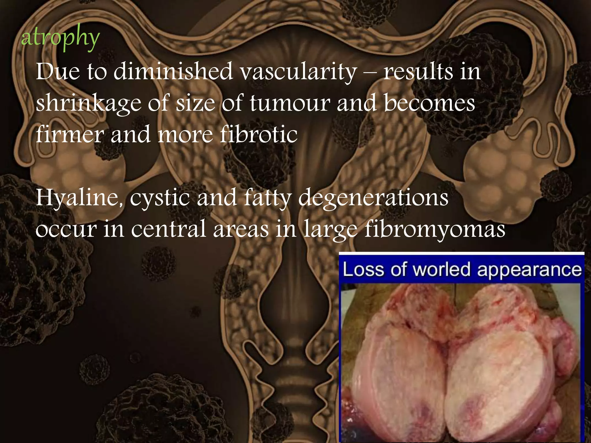 complications and degerations of fibroids | PPTX