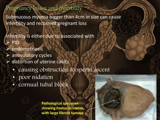 complications and degerations of fibroids | PPTX | Pregnancy ...