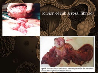 complications and degerations of fibroids | PPTX | Pregnancy ...