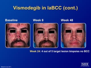 Erivedge Before And After