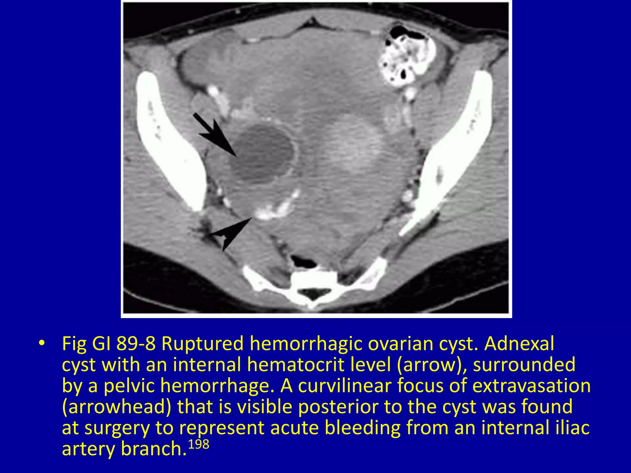 89 hemoperitoneum | PPTX
