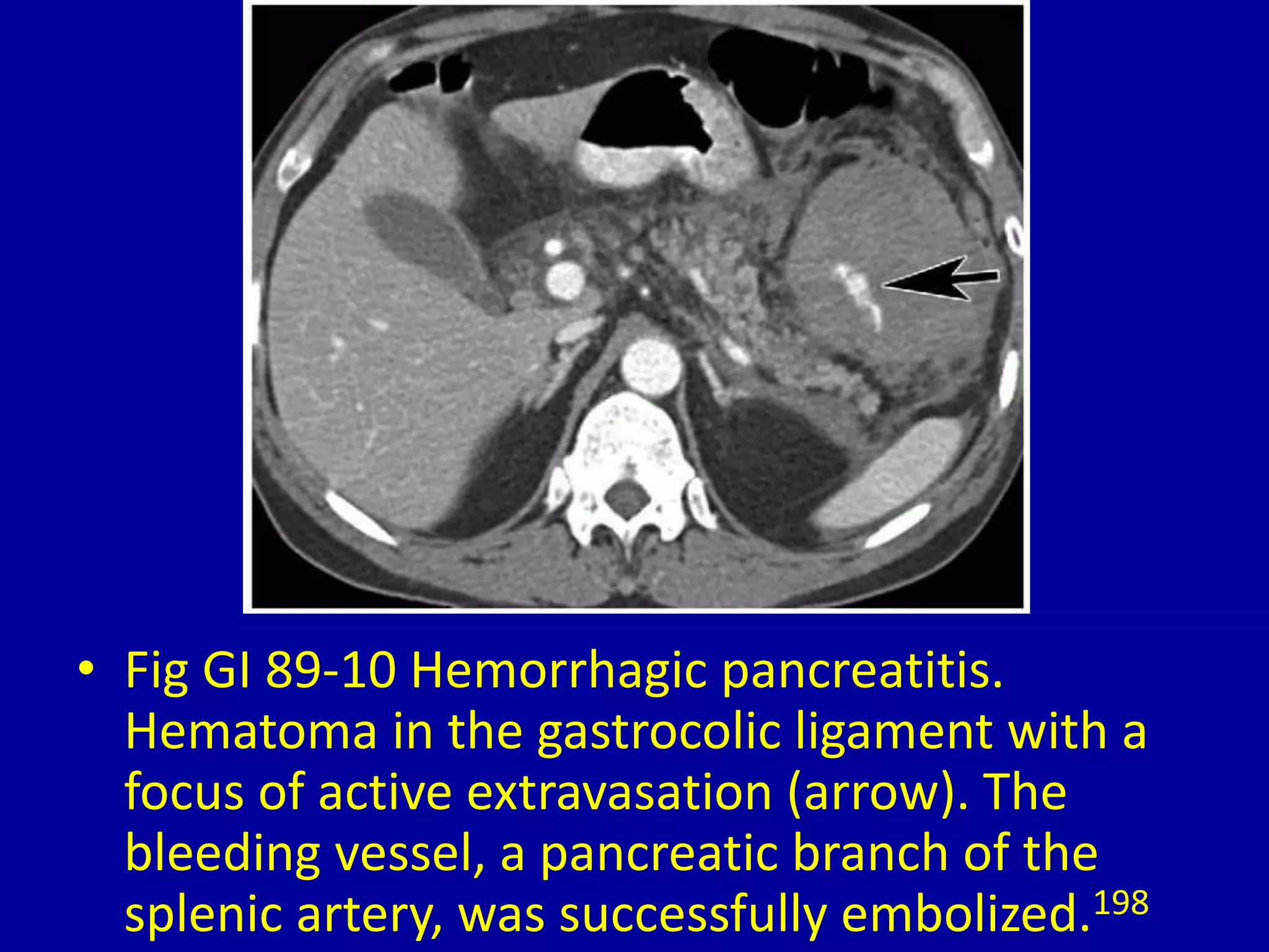 89 hemoperitoneum | PPTX