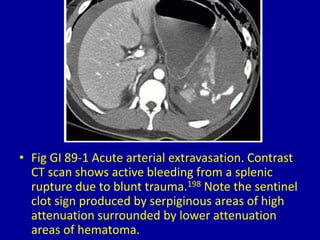 89 hemoperitoneum | PPTX