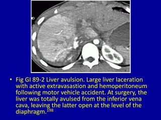 89 hemoperitoneum | PPTX