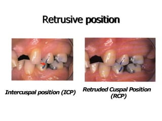 8,9 mandibular movements ( white ).pdbbf | PDF