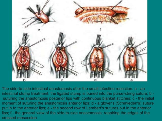 8 abdominal cavity surgery helpexams.ppt