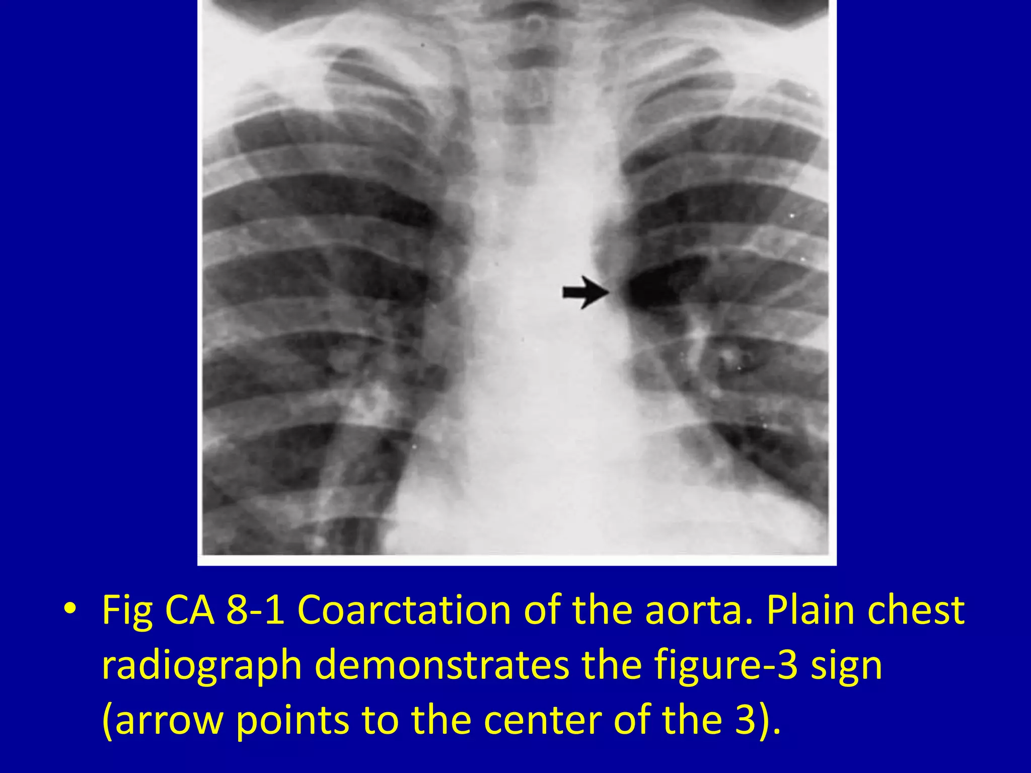 8 acyanotic congenital heart disease with normal pulmonary | PPTX