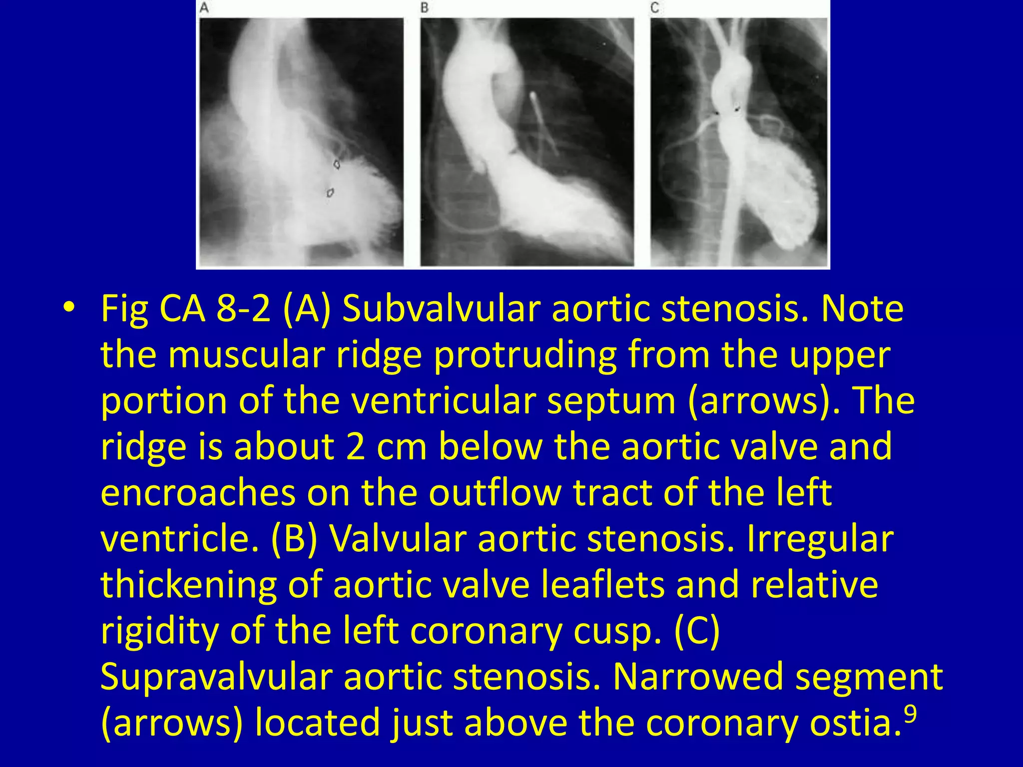 8 acyanotic congenital heart disease with normal pulmonary | PPTX