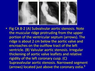 8 acyanotic congenital heart disease with normal pulmonary | PPTX