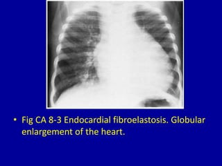 8 acyanotic congenital heart disease with normal pulmonary | PPTX