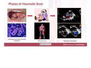 8 Acute rheumatic fever Rheumatic heart disease 2025.pptx