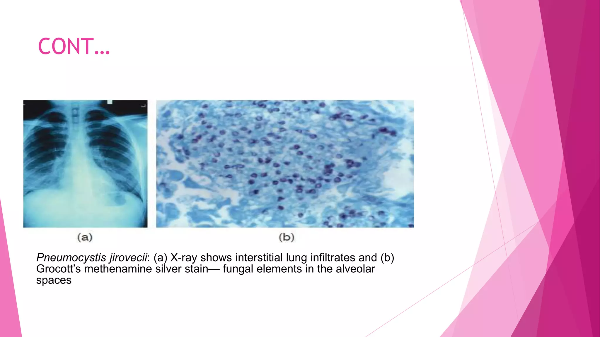 8 august FUNGAL INFECTIONS OF RESPIRATORY TRACT.pptx
