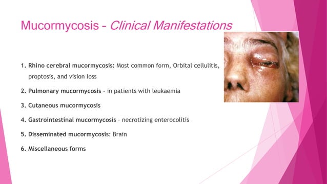 8 august FUNGAL INFECTIONS OF RESPIRATORY TRACT.pptx | Lung and ...