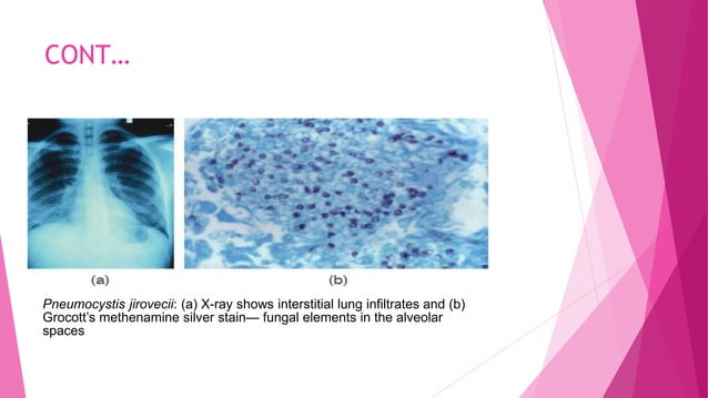 8 august FUNGAL INFECTIONS OF RESPIRATORY TRACT.pptx | Lung and ...