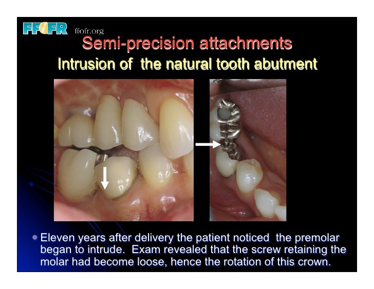 Biomechanics and Treatment Planning